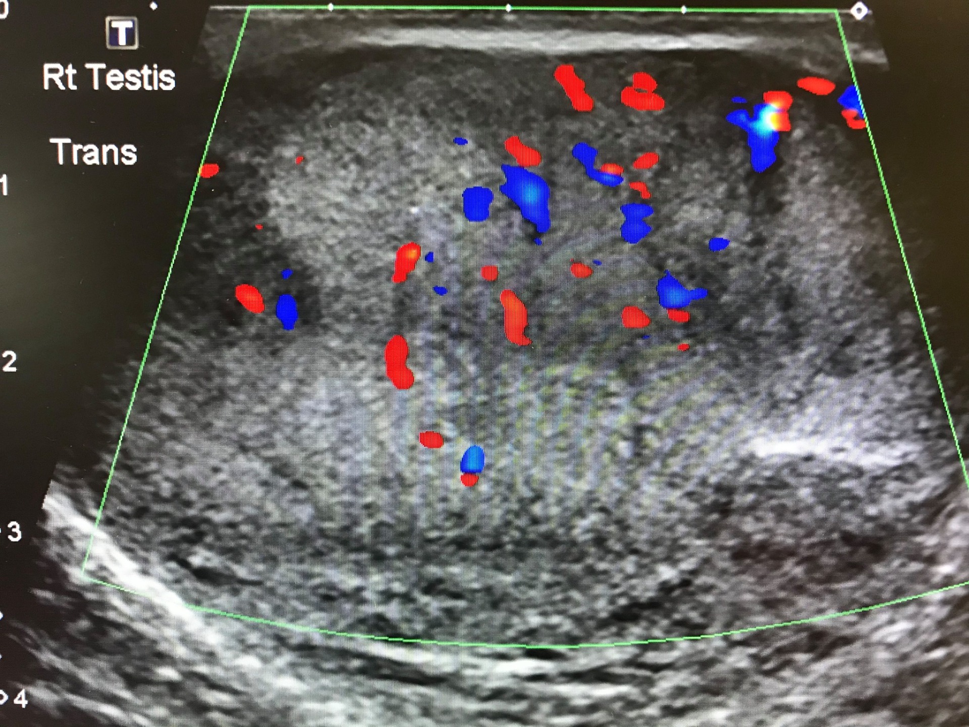 Testicular pain and swelling :: MelbourneUS