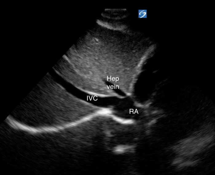 IVC :: POCUS