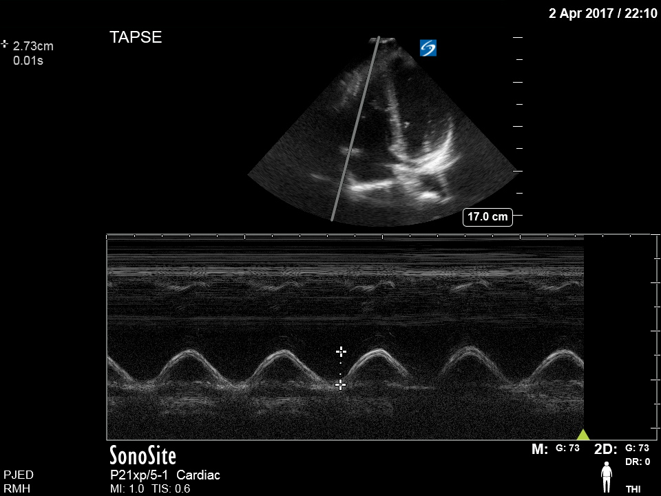 The Right Ventricle :: MelbourneUS
