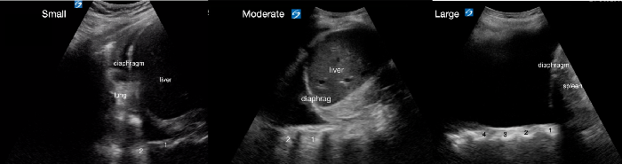 pleural effusion :: POCUS