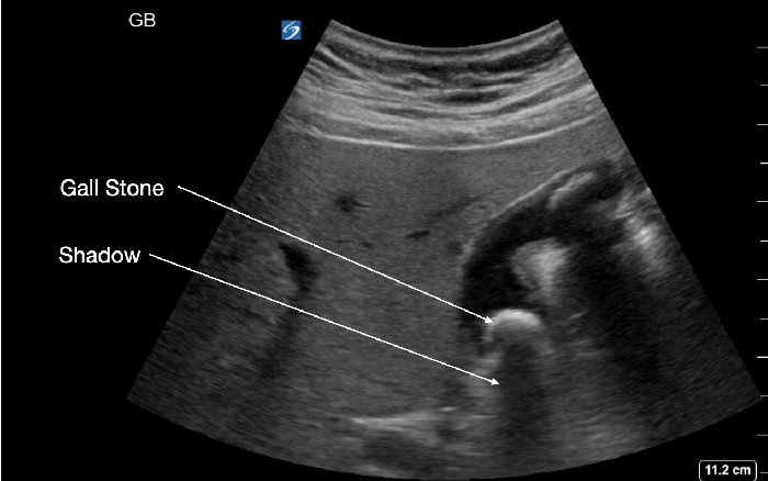 Artifacts :: POCUS