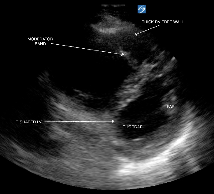 RV Dysfunction :: POCUS