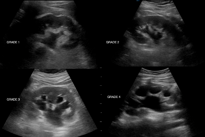 Hydronephrosis :: MelbourneUS