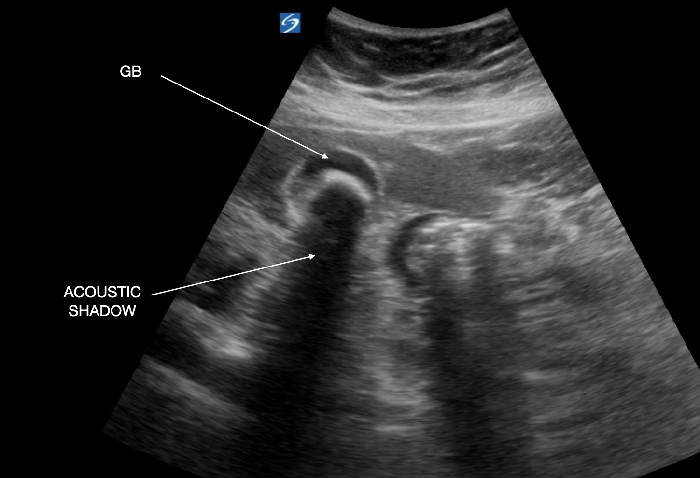 Cholecystitis :: POCUS