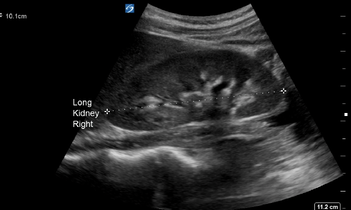 Complicated Pyelonephritis :: POCUS