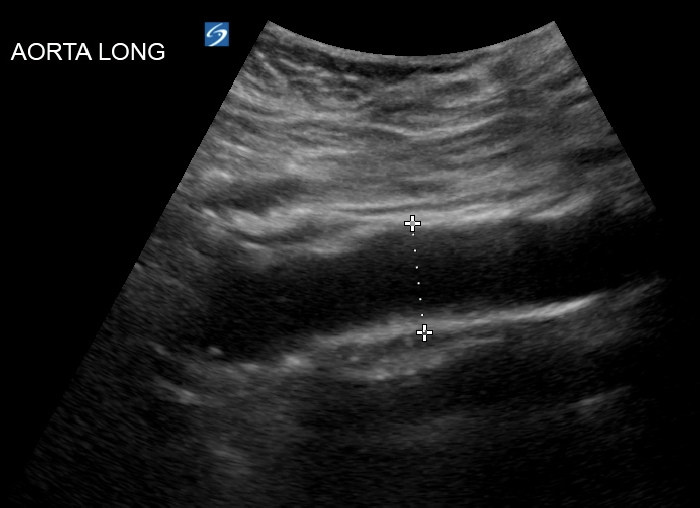 LIF pain and vomitting :: POCUS