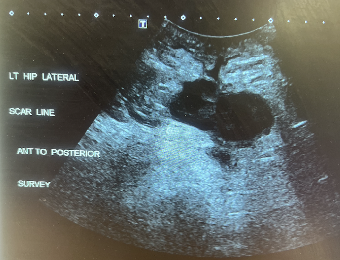 Scar Cellulitis :: POCUS